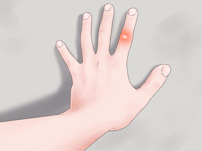 Get To Know Your Bug Bites: A Guide – Dougie Boom's Cottage Country Mix